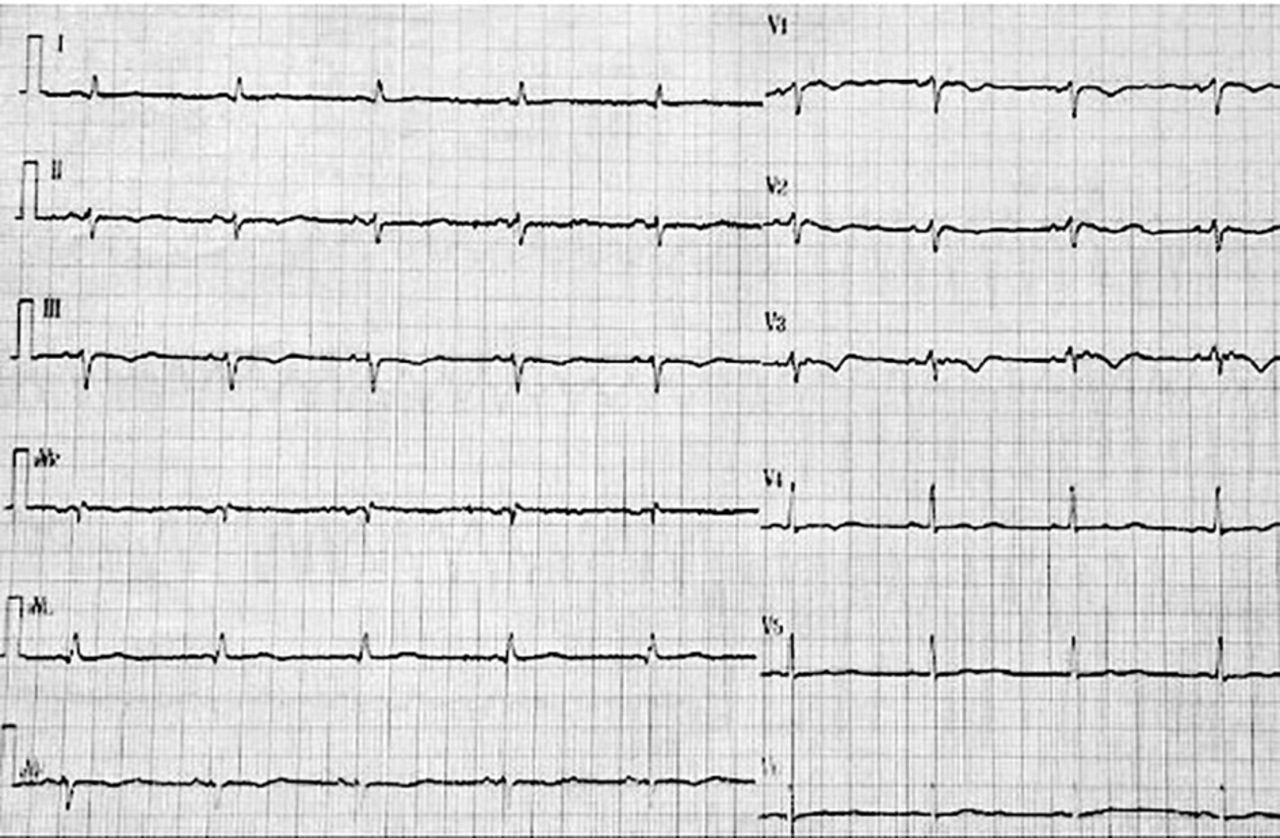 Arrhythmogenic Right Ventricular Dysplasia Ecg